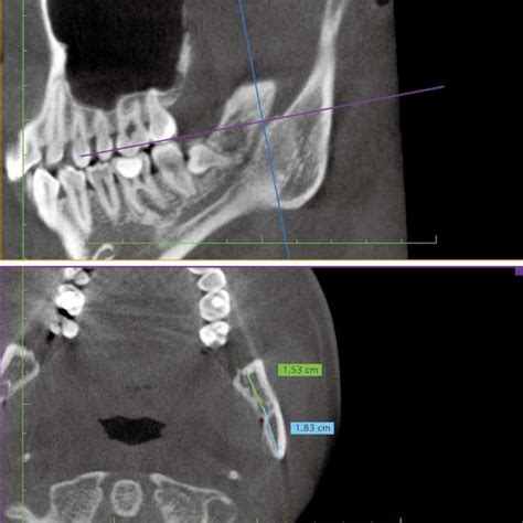 Pdf Cone Beam Computed Tomography Of Mandibular Foramen And Lingula For Mandibular Anesthesia