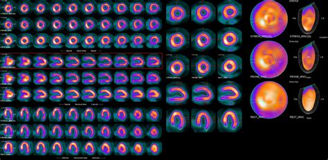 Marked Multi Distribution Myocardial Ischemia In A Patient With