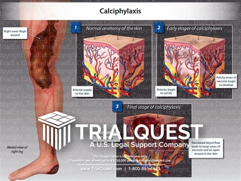 Calciphylaxis Trialexhibits Inc