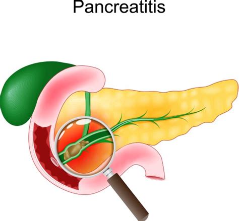 Endometriosis Cross Section Of A Human Uterus Vector Image