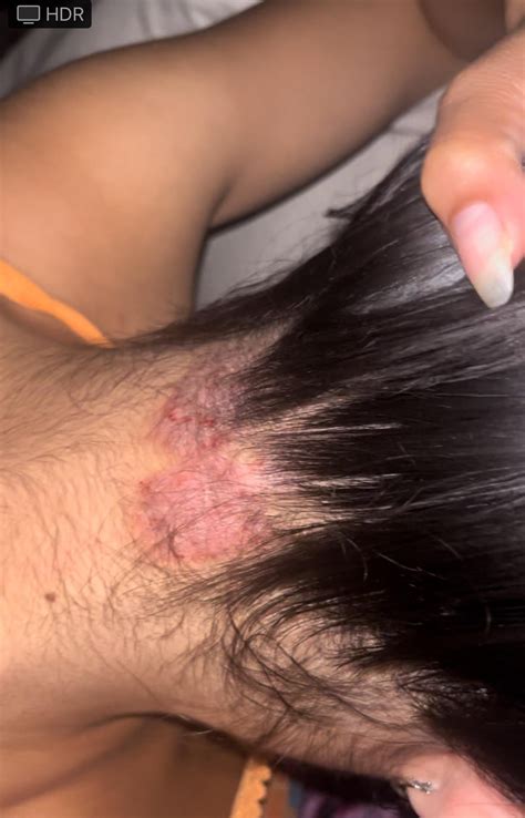 Scalp Irritation R Dermatologyquestions