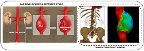 Detecting Predicting And Preventing Aortic Ruptures With Computational