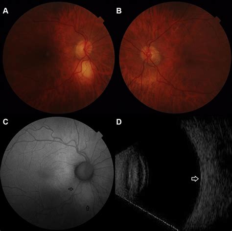 Multimodal Imaging Features Of Focal Scleral Nodule Imcrj Imcrj