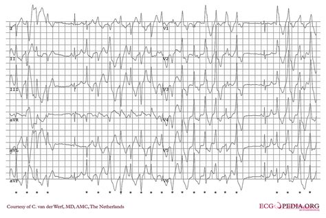 Pulseless Ventricular Tachycardia Classification Wikidoc