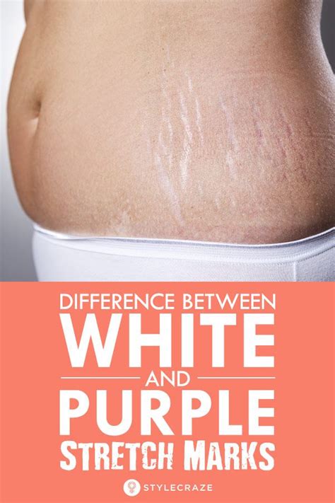 Do You The Know The Difference Between White Stretch Marks And Purple