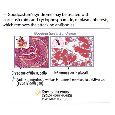 Pathology Glossary Goodpastures Syndrome Draw It To Know It