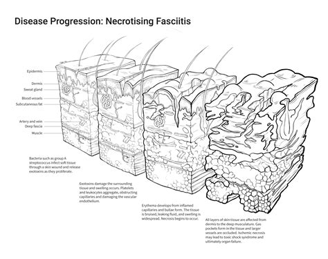 Necrotizing Fasciitis Definition