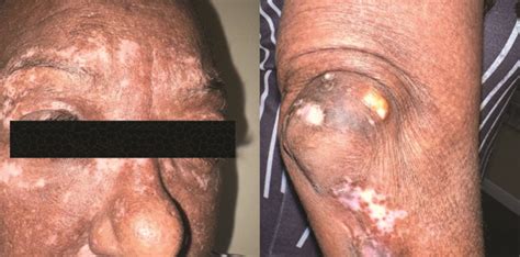 Pseudophakic Cystoid Macular Edema Cme Is A Known Possible Complication… Optometry Times