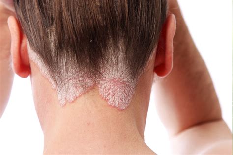 Home Remedies For Scalp Fungus