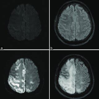 Axial Diffusion Weighted Imaging DWI A And Fluid Attenuated