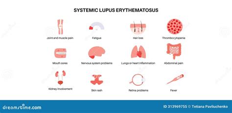 Systemic Lupus Erythematosus Vector Illustration 313720246