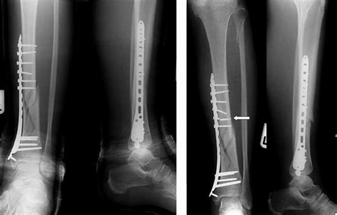 Radiographs Of The Patient Who Presented A Fracture Of One Proximal Download Scientific