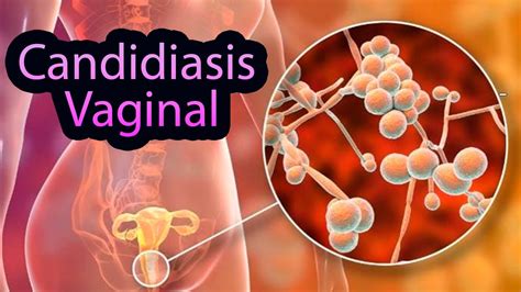 La Candidiasis Vaginal Candidosis Moniliasis Y Oidiomicosis Youtube