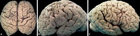 Segment Numbers Of Precentral Sulcus A Inferior Precentral Sulcus Download Scientific Diagram
