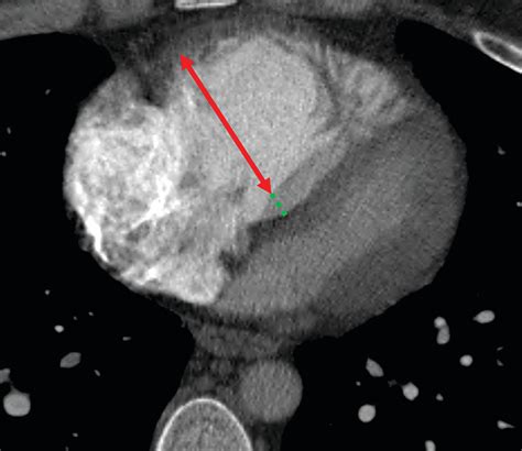 Diagnostic Accuracy Of Sex Specific Chest Ct Measurements Compared With