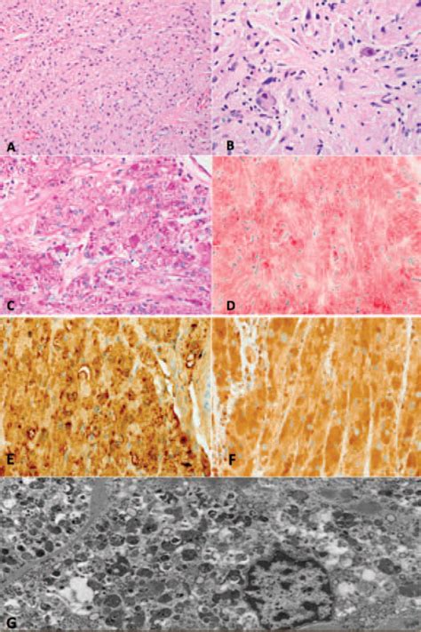 Ganglion Cell Tumor