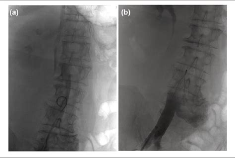 Figure 1 From A Modified Wire Loop Snare Technique For The Retrieval Of