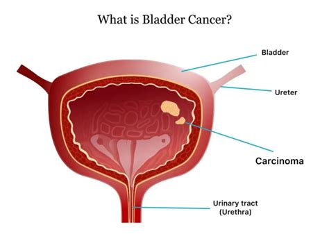 Bladder Cancer Detection Early Detection Why It Matters Dr Zubair Cheema