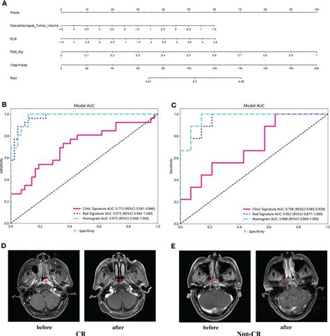 Mri Based Clinical Radiomics Nomogram May Predict The Early Response