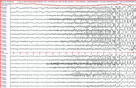 Ictal Eeg Reveals Background Attenuation Followed By Fast Rhythmic Ictal Eeg Reveals Background Attenuation Followed By Fast Rhythmic