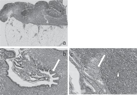 Figure 3 From A Case Of Intussusception Due To Inverted Meckels Diverticulum Preoperatively
