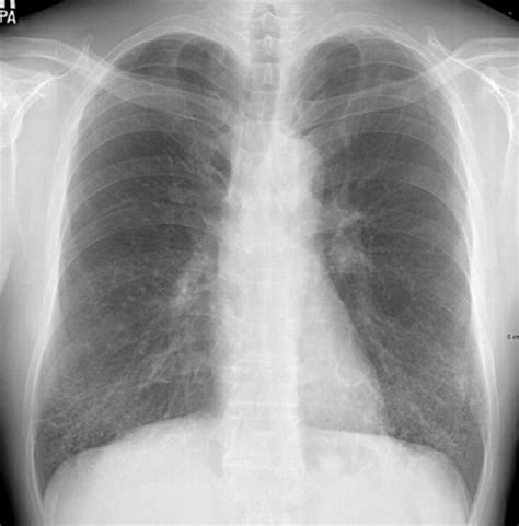 Interstitial Pneumonia X Ray