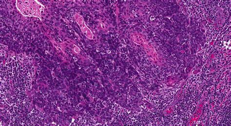 What Is Nonkeratinizing Squamous Cell Carcinoma Mypathologyreport