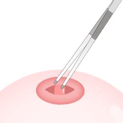 Inverted Nipples Vip Plastic Surgery Korea