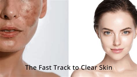 Pico Laser Before And After 1 Treatment Rheinlaser