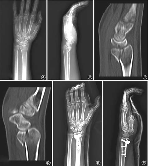 Volar Splitting And Collapsed Type Of Die‐punch Fracture Treated By