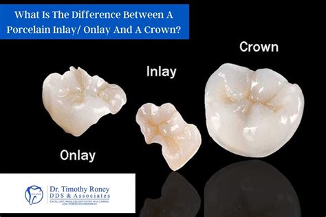 What Is The Difference Between A Porcelain Inlay Onlay And A Crown Dr Timothy Roney Dds