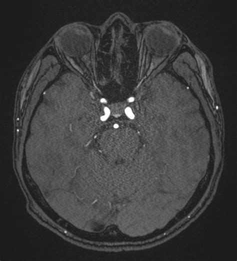Basal Ganglia Subacute Infarct Radiopaedia 80201 93521 Axial Mra Nc