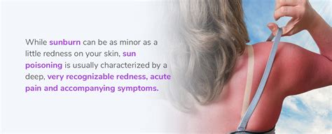 Sunburn Or Sun Poisoning Symptoms Treatments Prevention