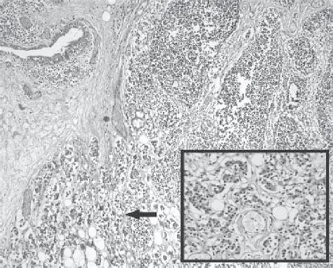 A Photomicrograph Showing Thymic Tissue With Adjacent Focus Of Download Scientific Diagram