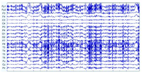 a group of eeg signals with emg noise download scientific diagram