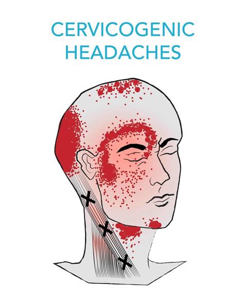Nepute Wellness Cervicogenic Headache Cgh Is A Type Of
