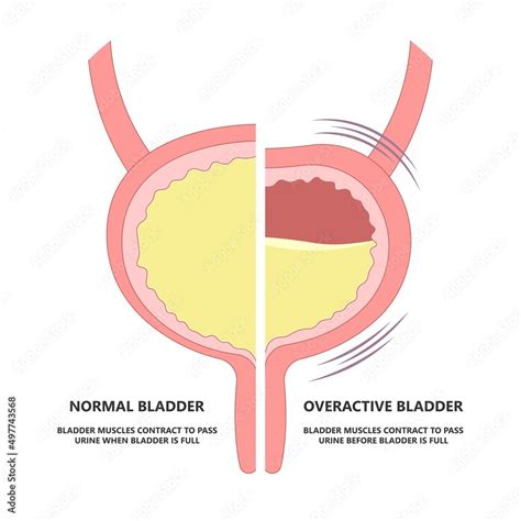 Cystitis Anuria Tumor Cancer Toilet Frequently Urination Urge Pass