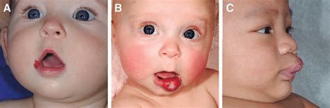 Superficial Hemangioma