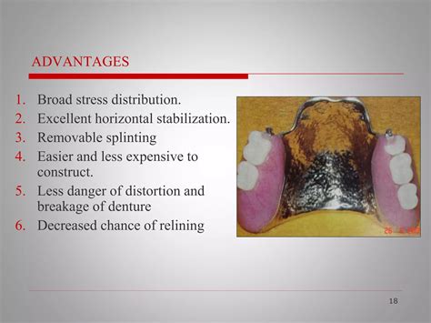 Designing For Kennedy Class I And Class Ii Ppt Oral Care Personal Care