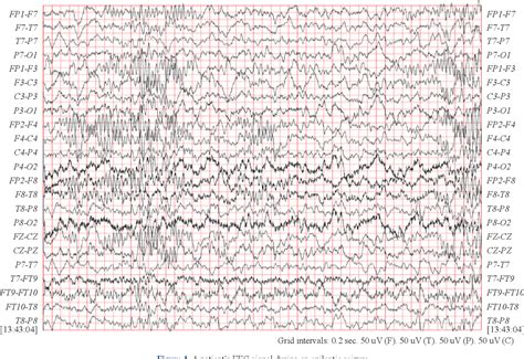 figure 1 from automatic epileptic seizure detection based on eeg