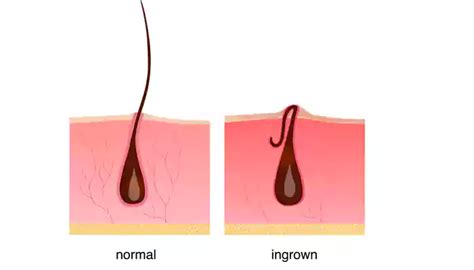 Loading Smooth Skin Ingrown Hair Symptoms Causes And Prevention