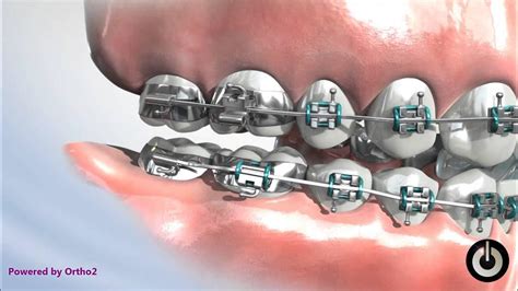 Class 2 Corrector Youtube