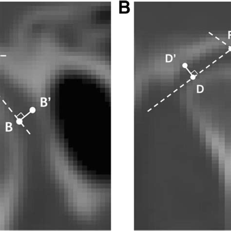 Landmarks And Linear Measurements For Condylar Position A Sagittal Download Scientific Diagram