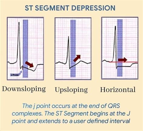 🔴 St Segment Depression 1 St Depression Can Be Either Upsloping Downsloping Or Horizontal 2