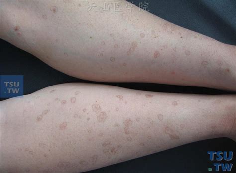 汗孔角化症porokeratosis of mibelli症状表现 皮肤病学 天山医学院