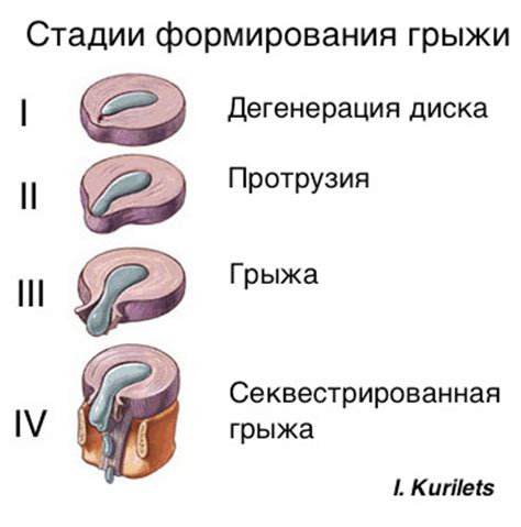 Межпозвоночная грыжа, остеохондроз, лечение межпозвоночной грыжи ...