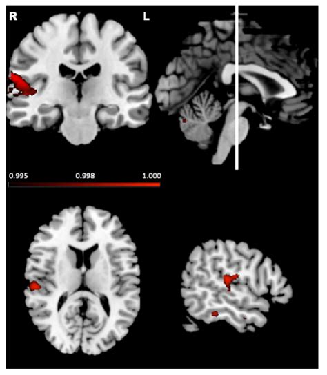 Voxel Based Morphometry Analyses In Left Lateralised Semantic Download Scientific Diagram