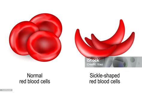 Eritrosit Normal Dan Sel Darah Merah Berbentuk Sabit Ilustrasi Stok