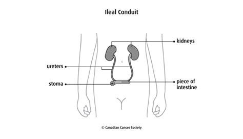Urinary Diversion Canadian Cancer Society Urinary Diversion Canadian Cancer Society