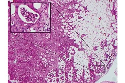 Kras Mutation Types Shape Pancreatic Cancer Outcomes Headline Horizon